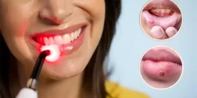 Red Light Therapy for Cold Sores: Does It Effectively Work?